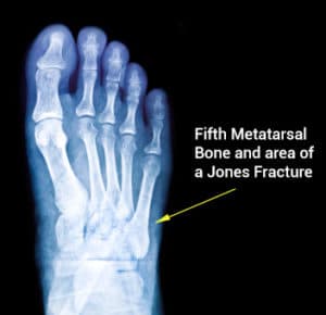 Jones Fracture: Symptoms, Treatments, Surgery & Recovery