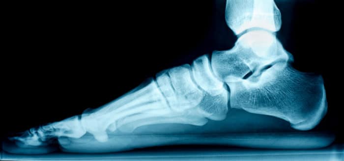 Charcot Foot – Causes, Diagnosis, Treatment and More | iWALKFree