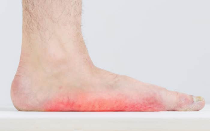 Charcot Foot – Causes, Diagnosis, Treatment and More | iWALKFree