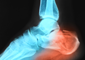 Broken Heel: Symptoms, Causes, Treatments, Surgery & Recovery